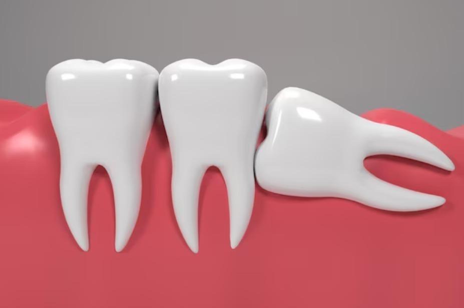 What Are the Best Aftercare Tips After Wisdom Tooth Removal?